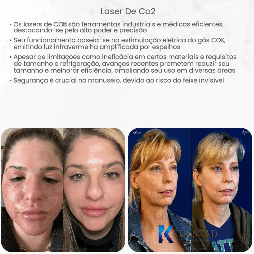 Laser de CO2 | Como funciona, aplicação e vantagens