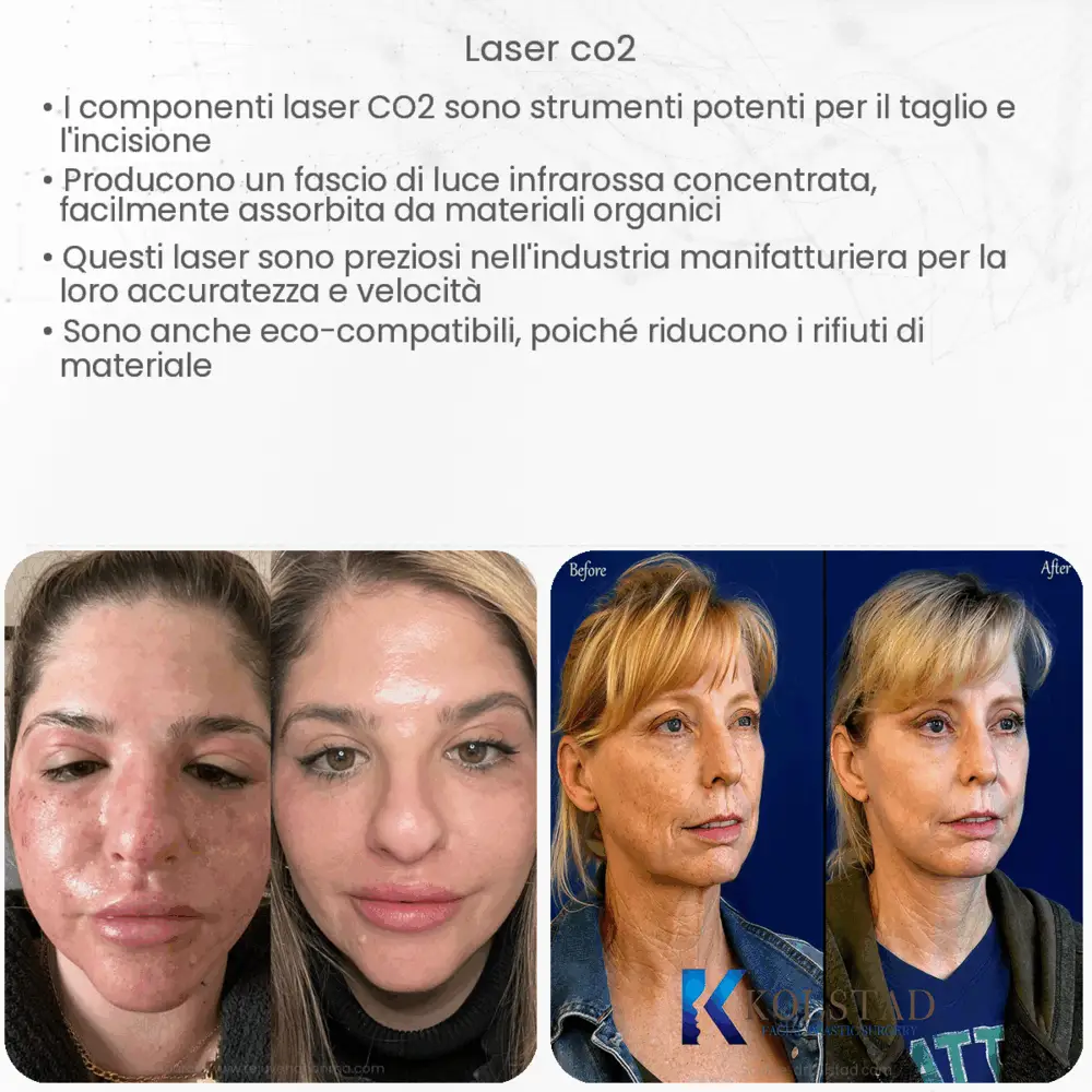 Laser CO2| Come funziona, Applicazione e Vantaggi